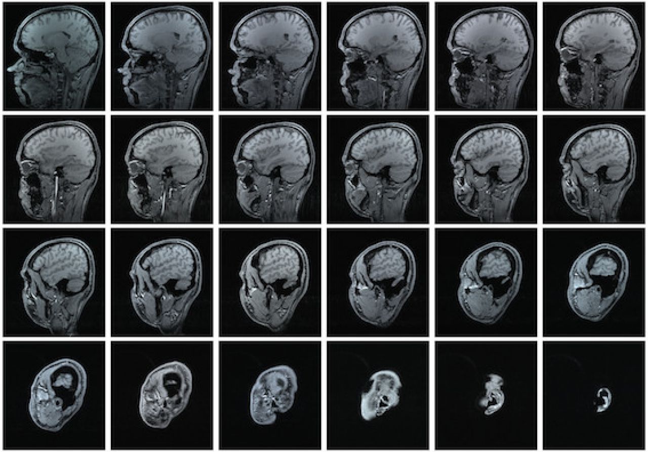Mapping how schizophrenia changes brains | Pursuit by the University of ...